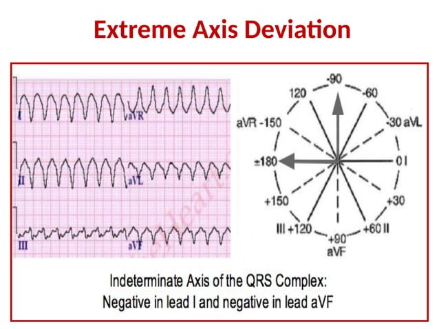 lecture on cardiac Axis on ecg for nurses | PPT