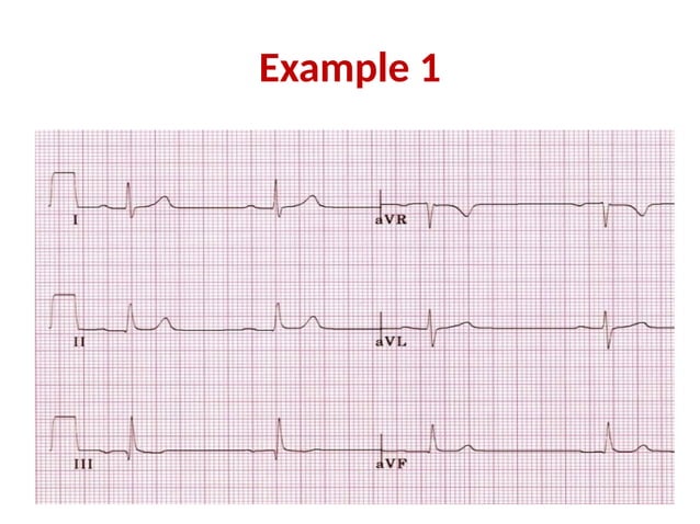 lecture on cardiac Axis on ecg for nurses | PPT