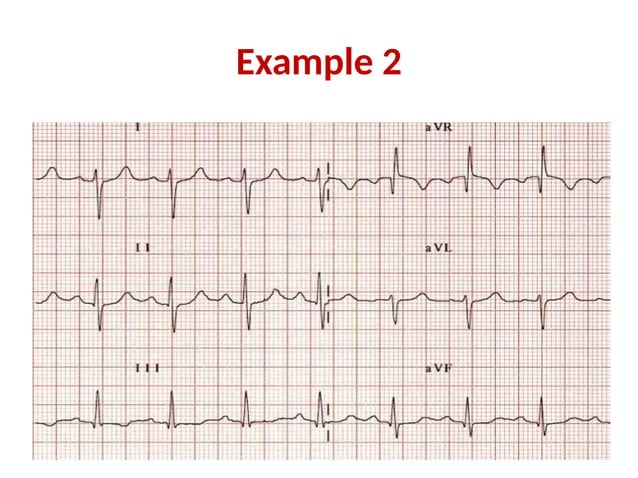 lecture on cardiac Axis on ecg for nurses | PPT