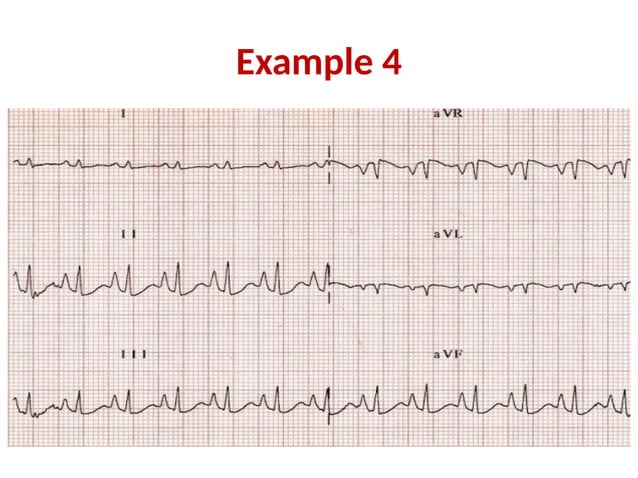 lecture on cardiac Axis on ecg for nurses | PPT
