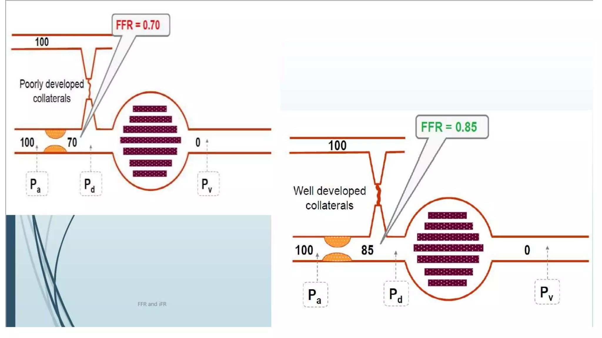 FFR(fractional flow reserve) | PPTX