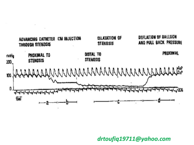 fractional flow reserve FFR dr md toufiqur rahman FSCAI FAHA FAPSIC | PPT