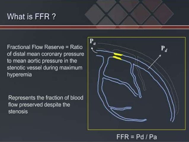 FFR with St. Jude System