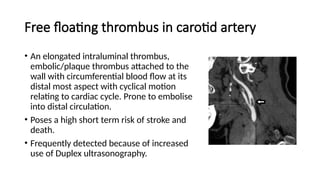 carotid endarterectomy in free floating thrombus.pptx