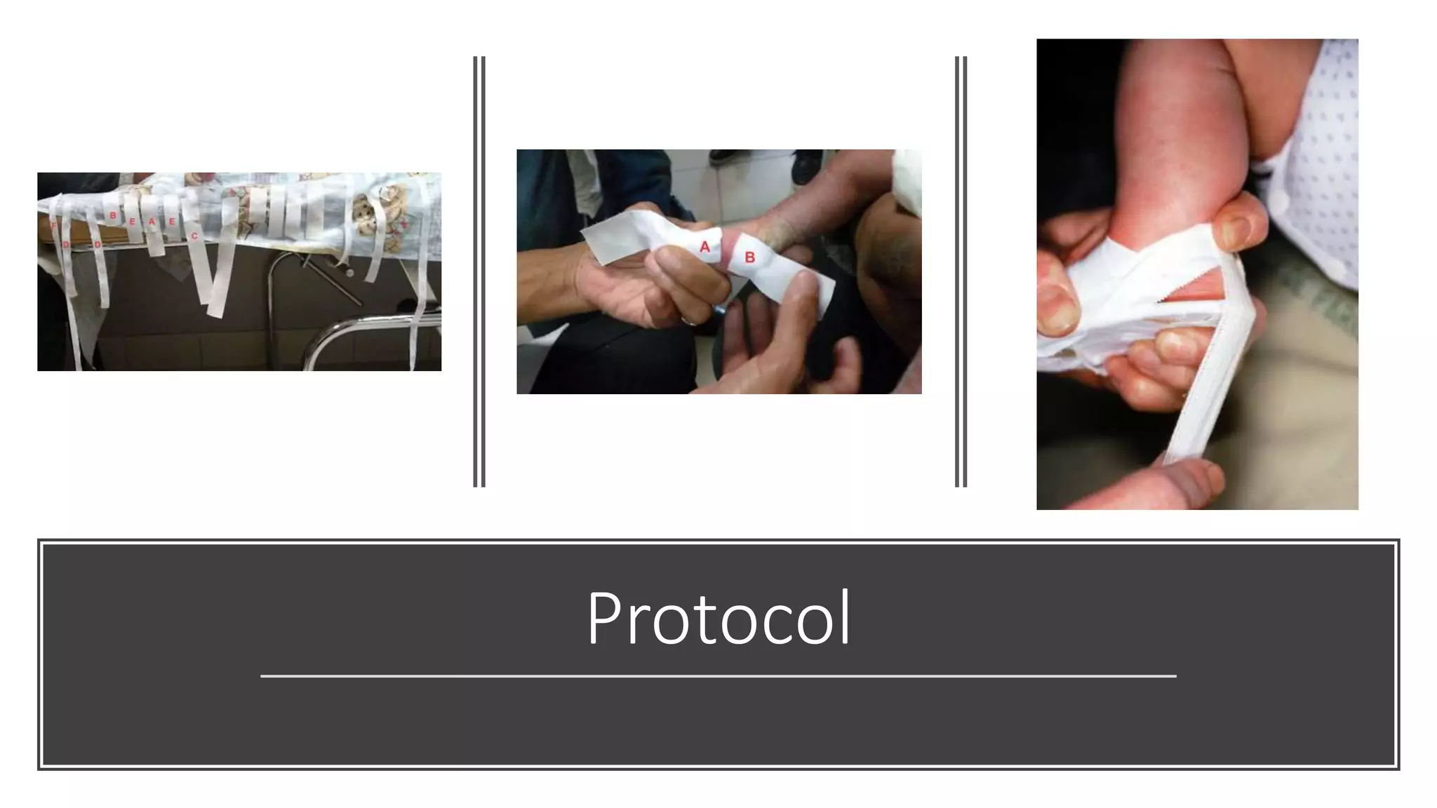 French Functional Method for Congenital Clubfoot: 20 years of ...