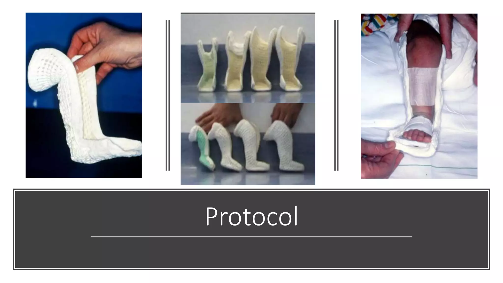 French Functional Method for Congenital Clubfoot: 20 years of ...
