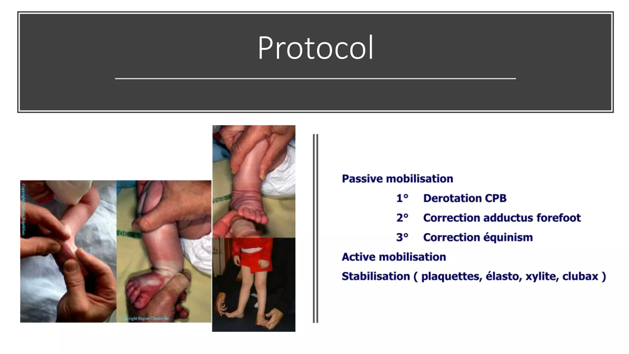 French Functional Method for Congenital Clubfoot: 20 years of ...