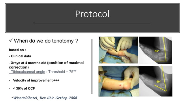 French Functional Method for Congenital Clubfoot: 20 years of ...