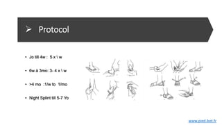 French Functional Method for Congenital Clubfoot: 20 years of ...