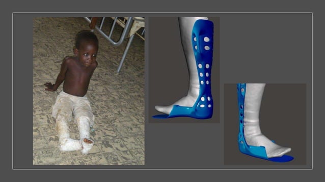 French Functional Method for Congenital Clubfoot: 20 years of ...
