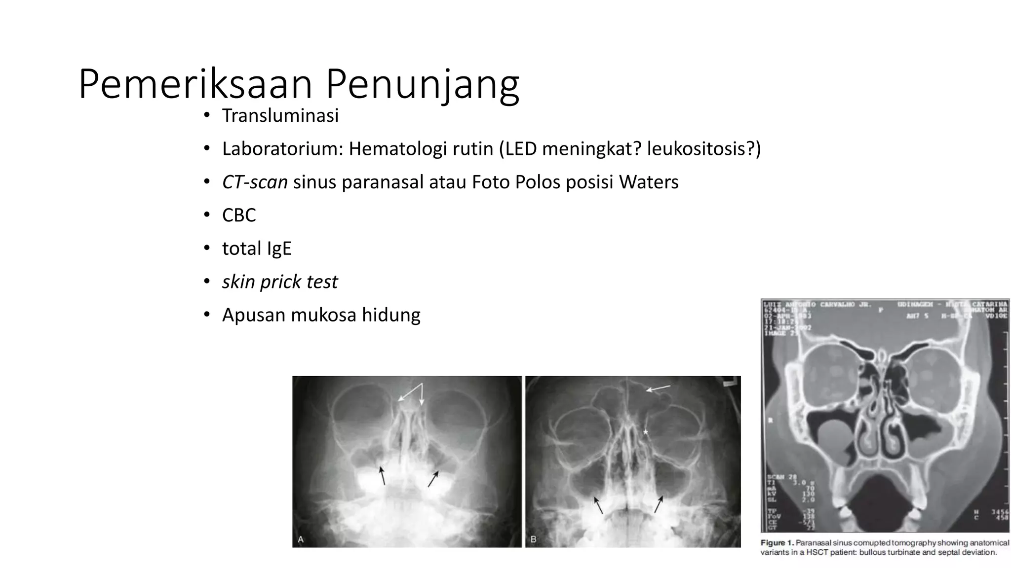 Rhinosinusitis kronis | PPTX