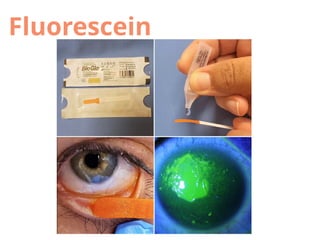 Staining of an eye (for students of optometry) | PPTX | Eye and Vision ...
