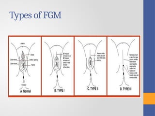 female genital mutilation circumstitpptx | PPT