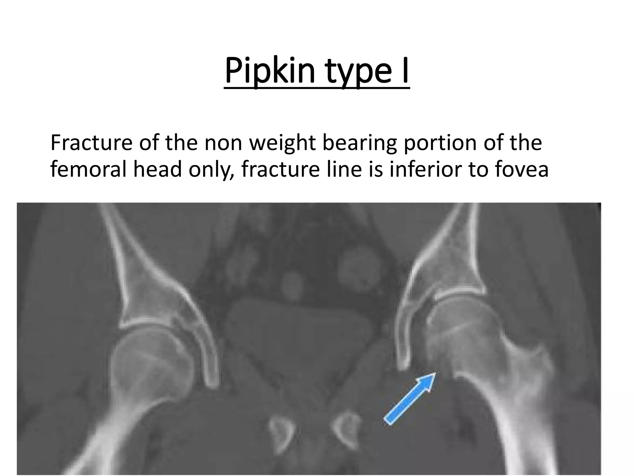 Femoral head fracture | PPTX
