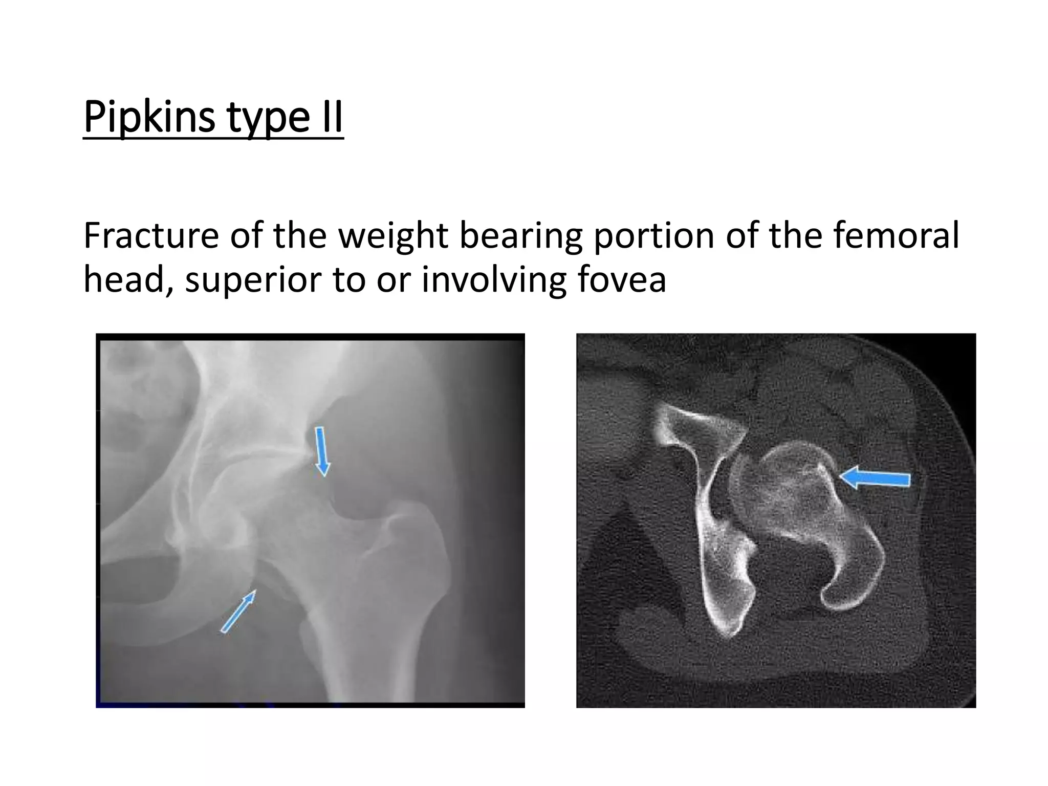 Femoral head fracture | PPTX