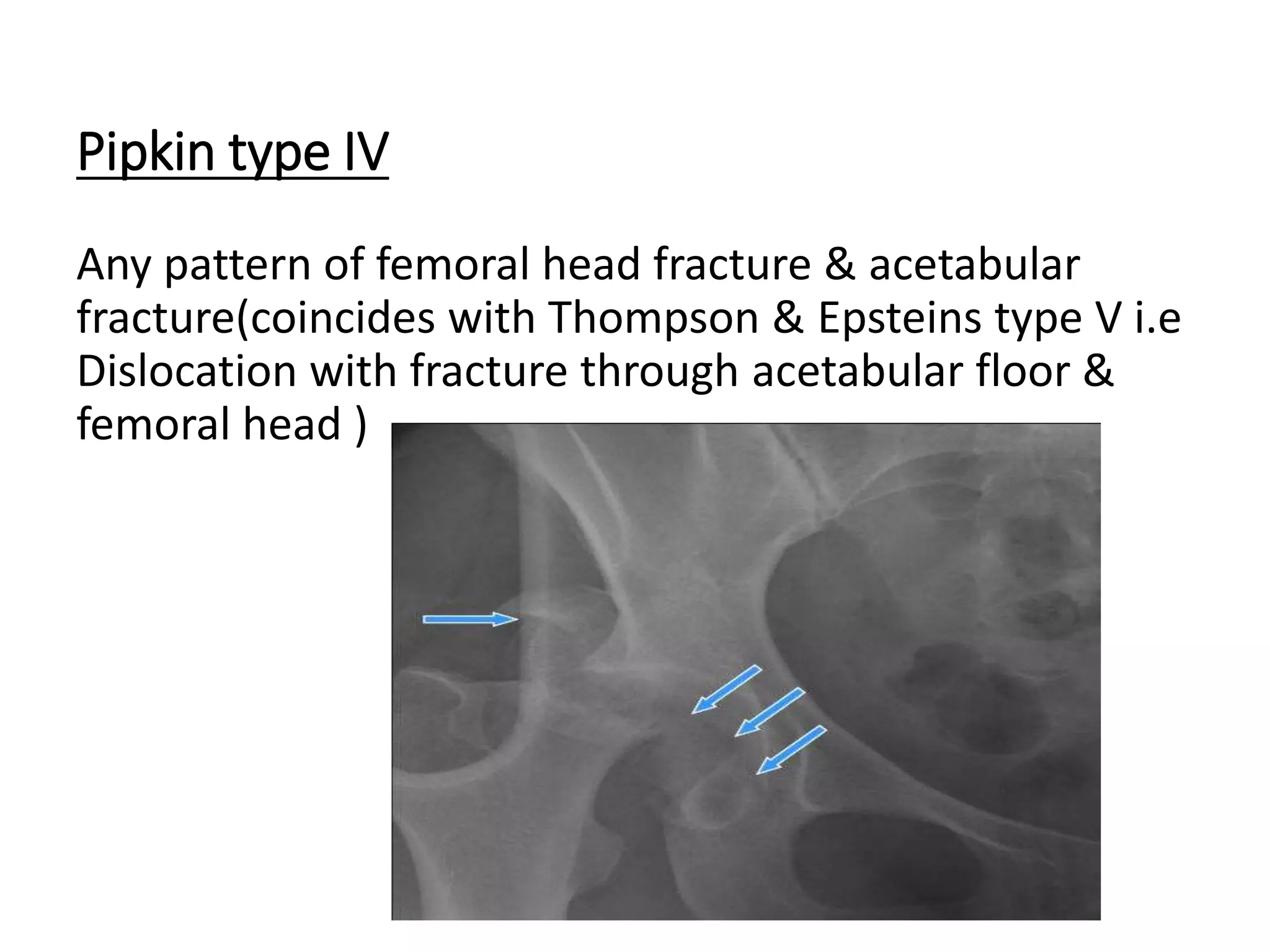 Femoral head fracture | PPTX