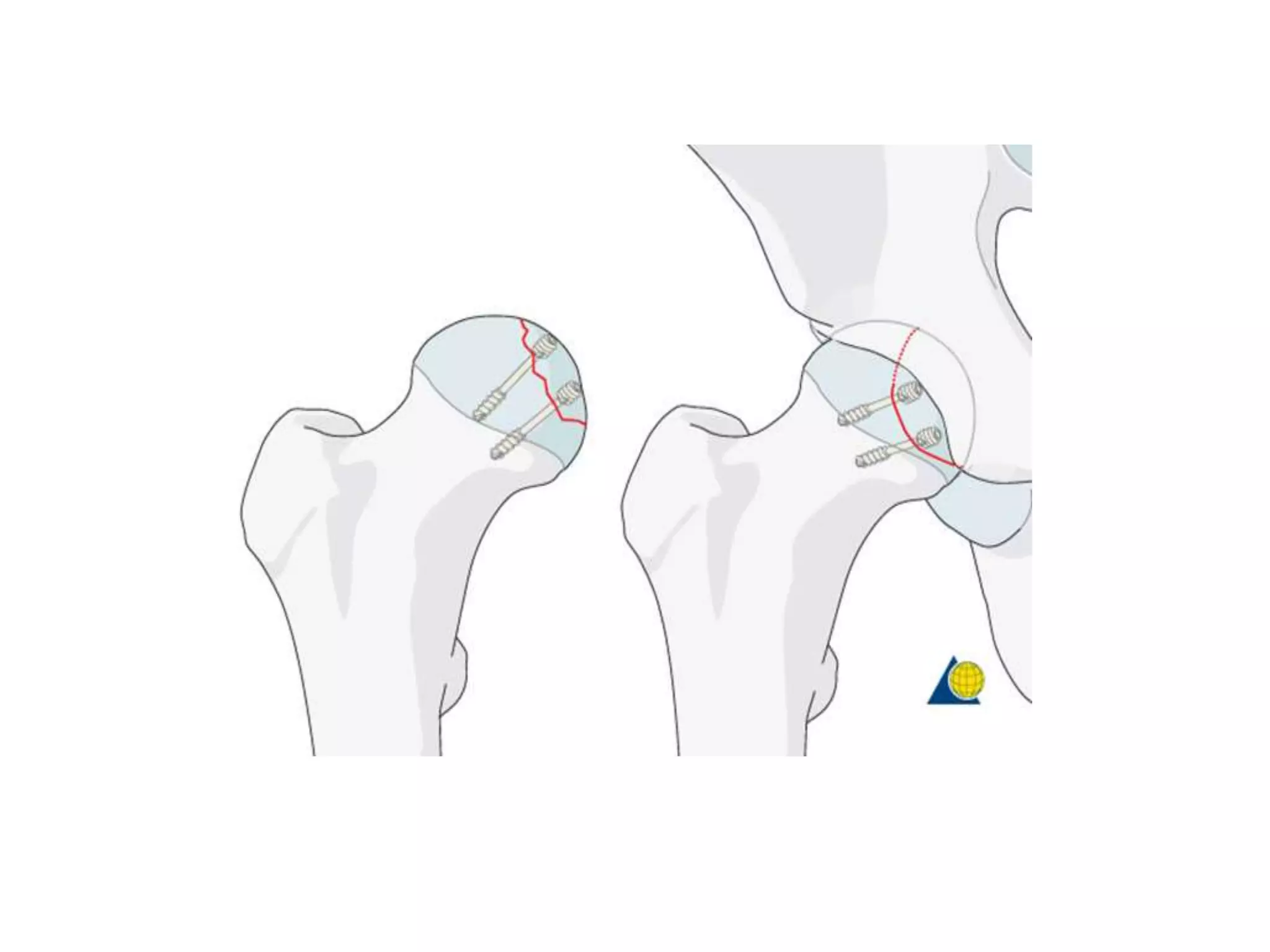 Femoral head fracture | PPTX