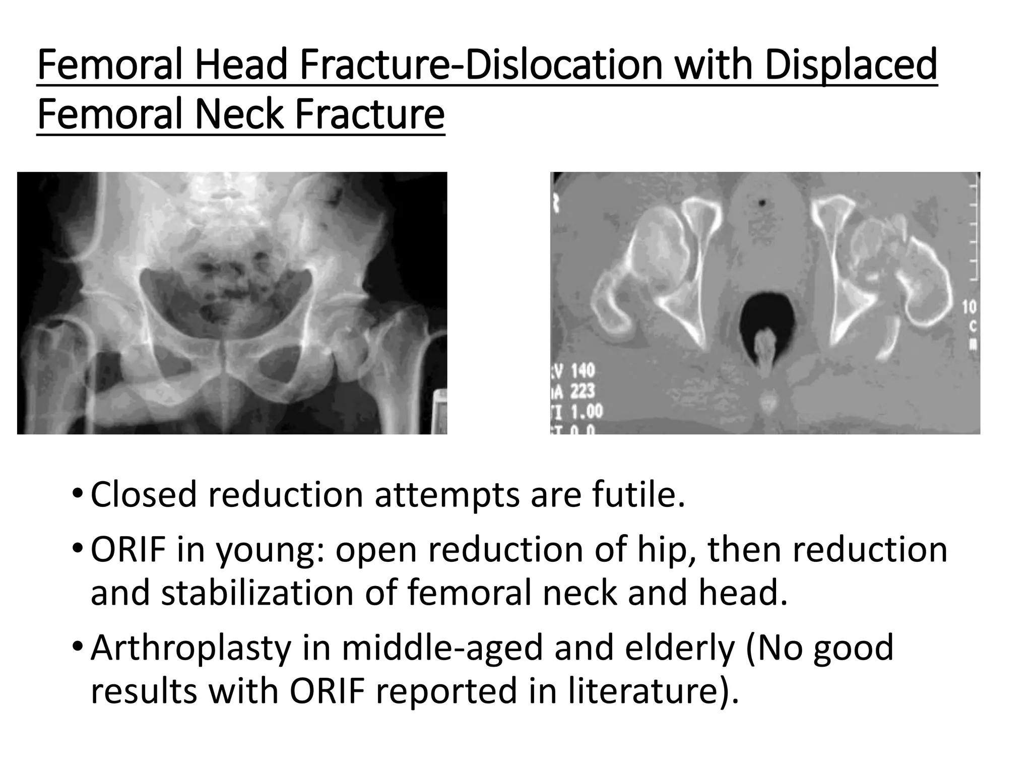 Femoral head fracture | PPTX