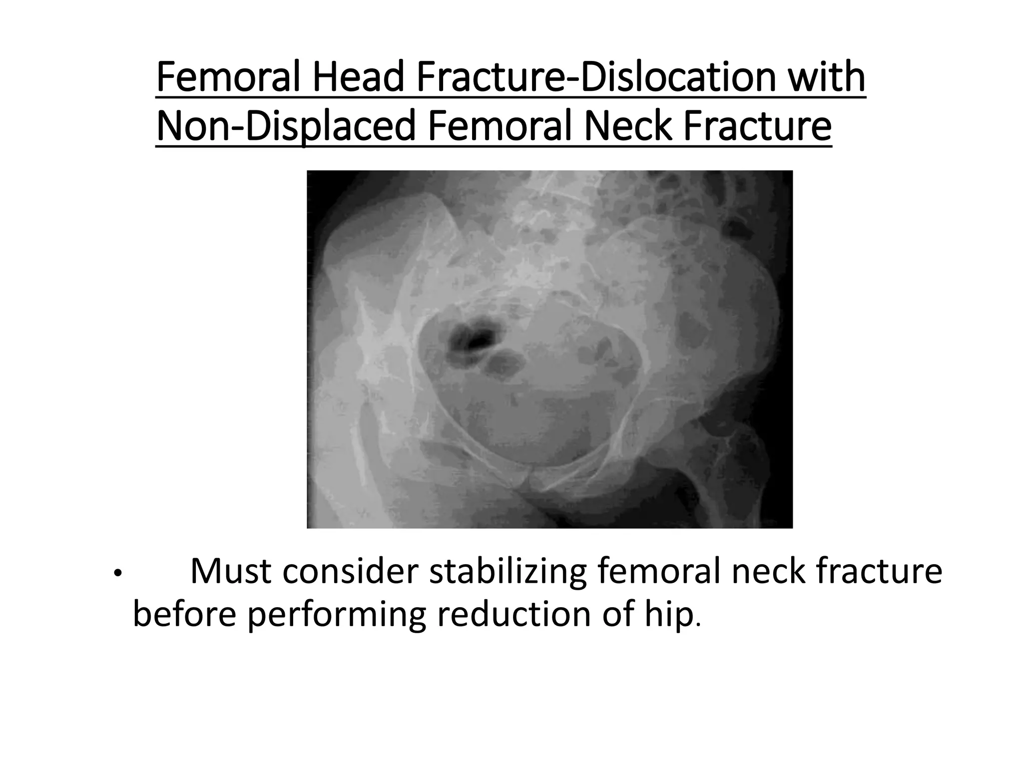 Femoral head fracture | PPTX