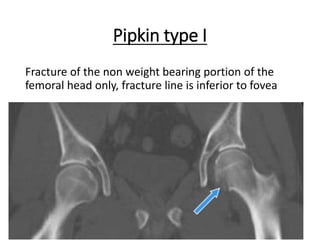 Femoral head fracture | PPTX