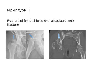 Femoral head fracture | PPTX