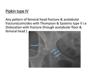 Femoral head fracture | PPTX