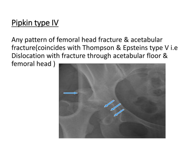 Femoral head fracture | PPTX