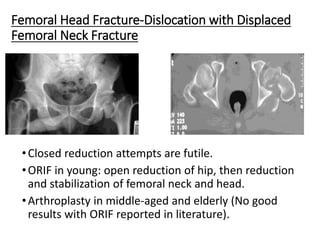 Femoral head fracture | PPTX