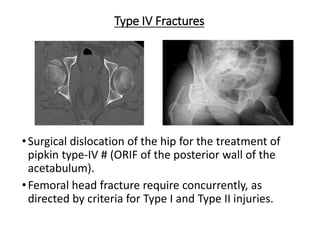 Femoral head fracture | PPTX