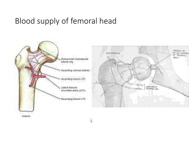 Femoral head fracture | PPTX