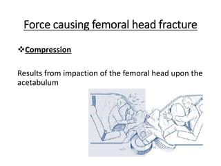 Femoral head fracture | PPTX