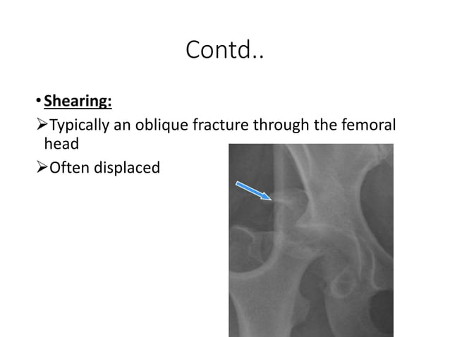 Femoral head fracture | PPTX