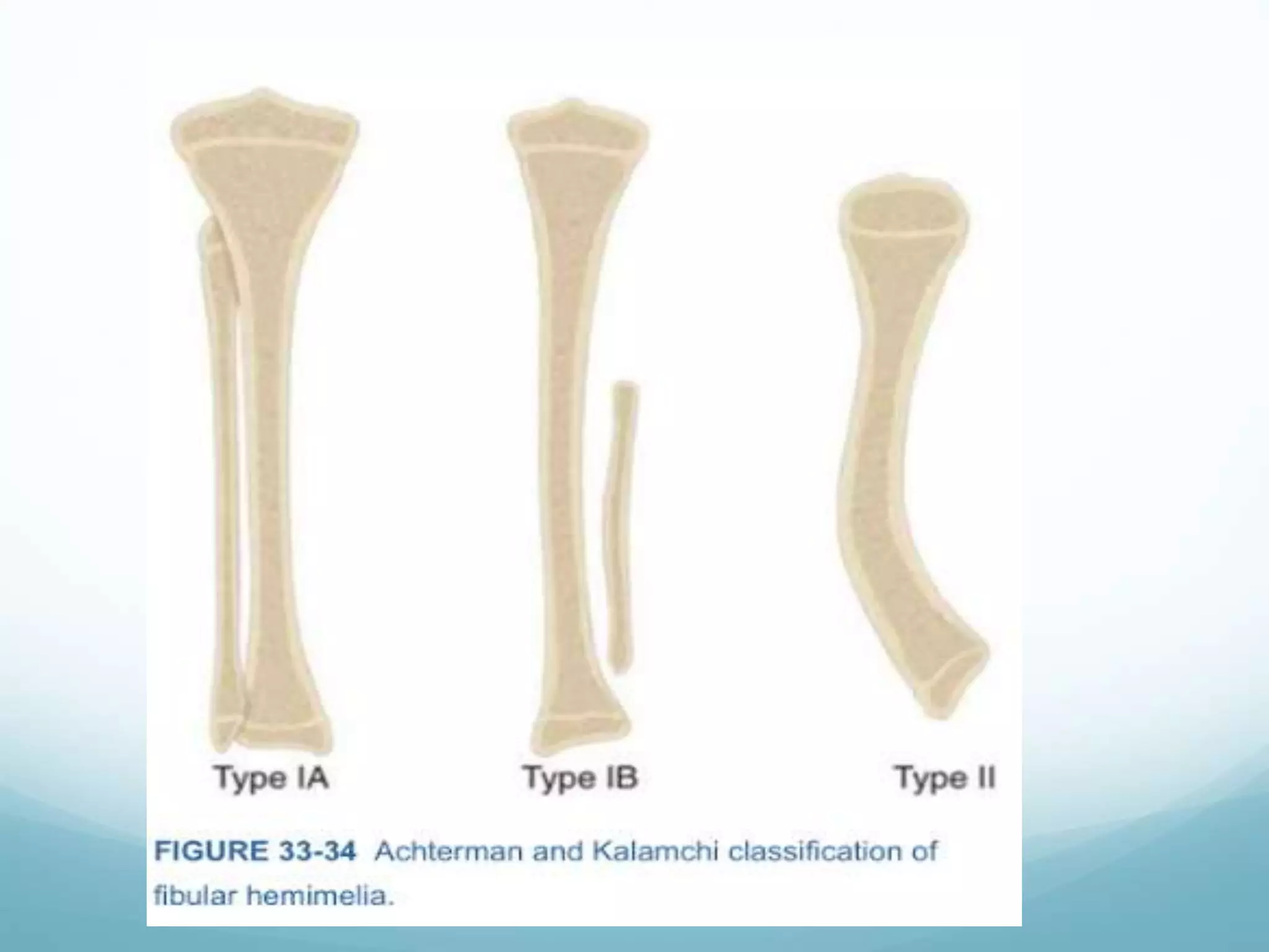 Fibular Hemimelia | PPTX