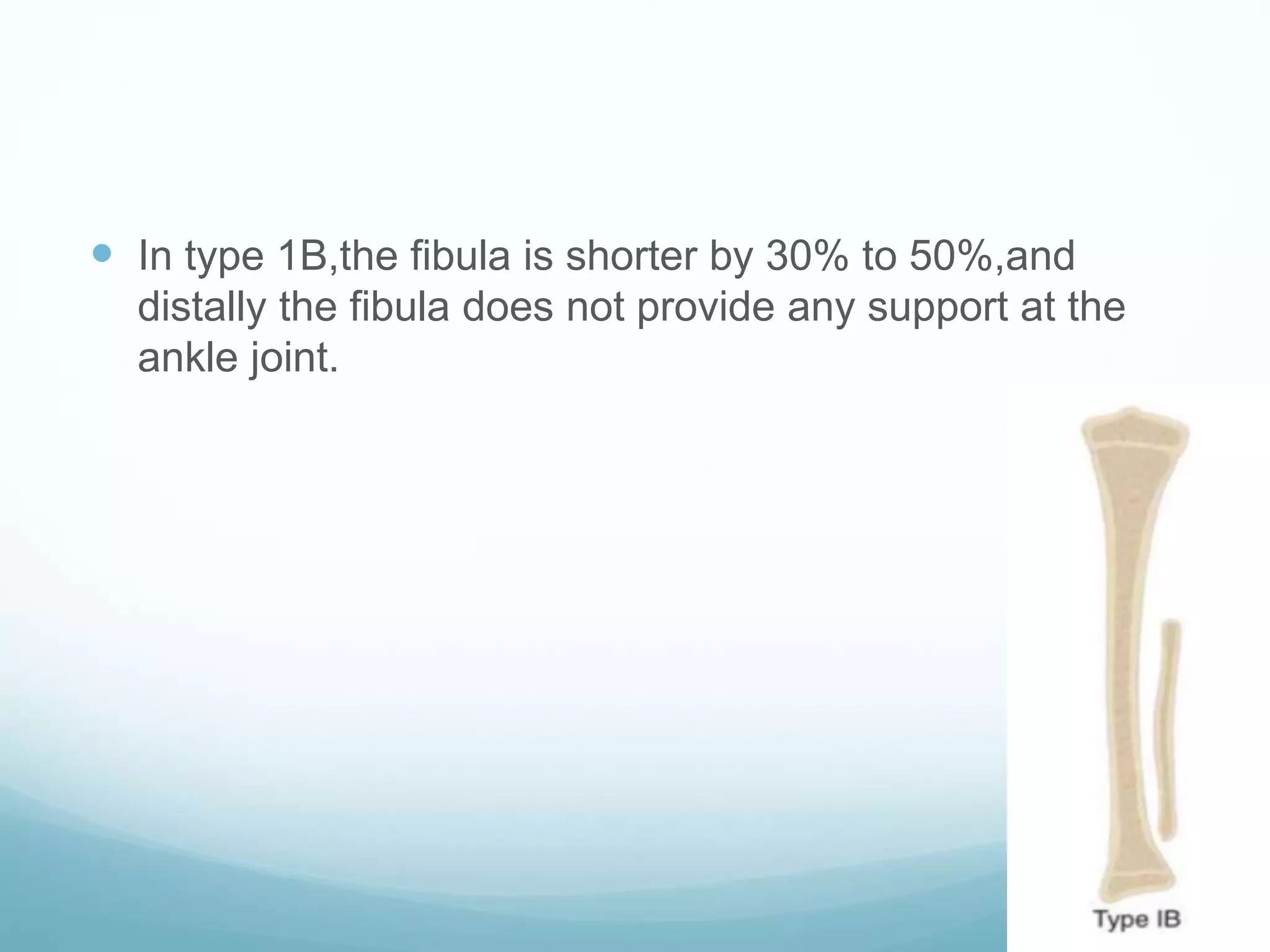 Fibular Hemimelia | PPTX