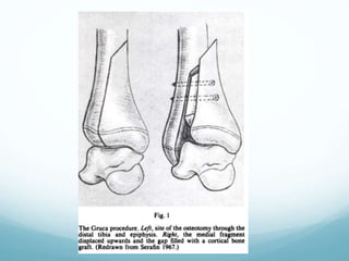 Fibular Hemimelia Diagram