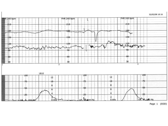 Fht interpretation & management | PPT