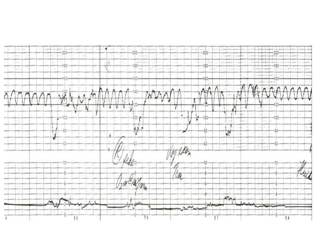 Fht interpretation & management | PPT