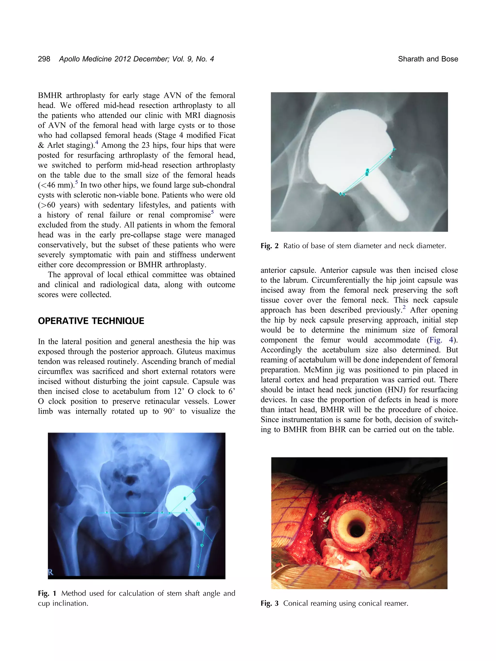 Birmingham mid-head resection arthroplasty of hip for avascular ...