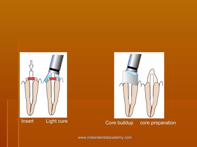 Fiber based post systems/ cosmetic dentistry training | PPT