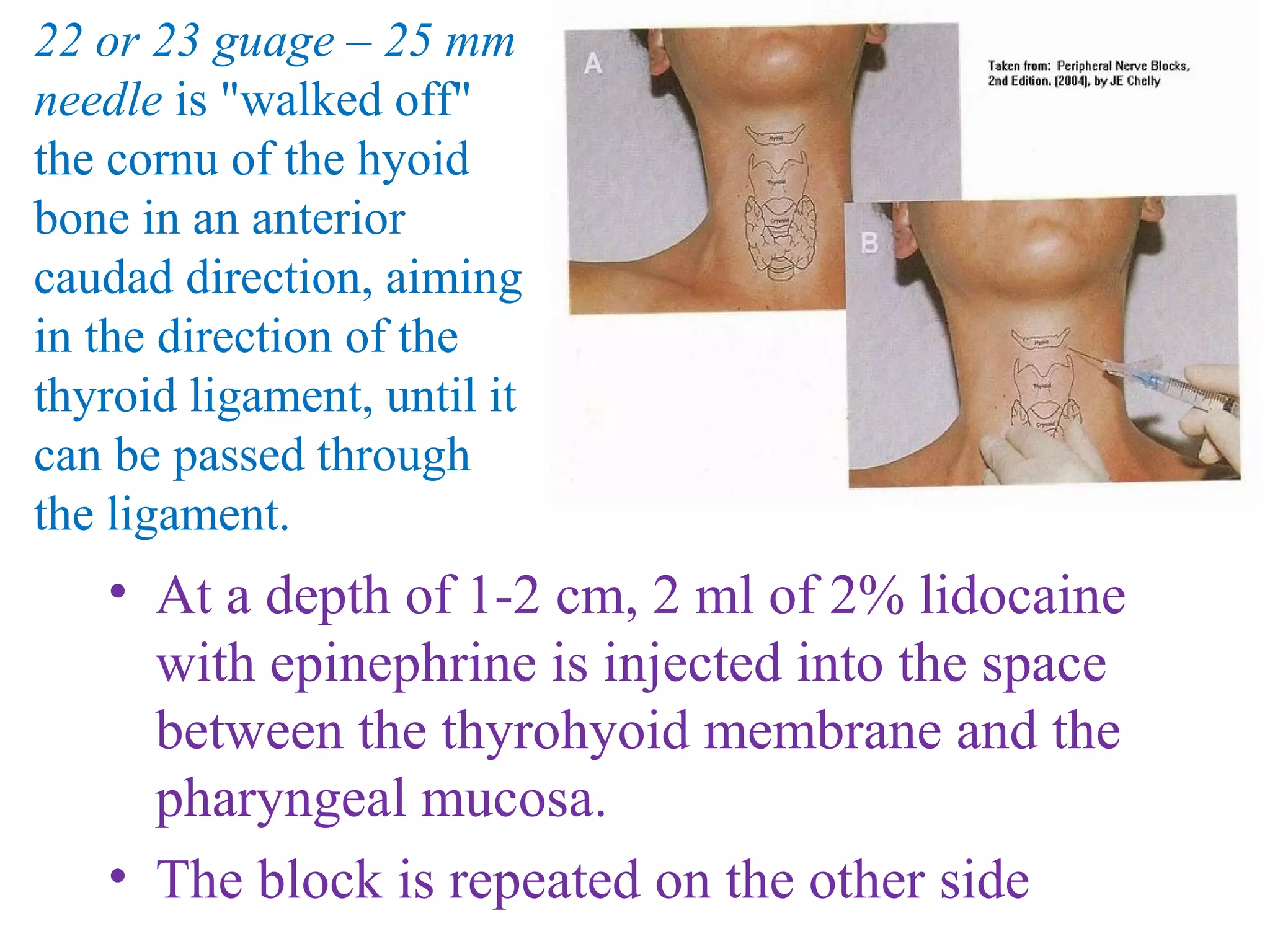 Fiberoptic intubation | PPT