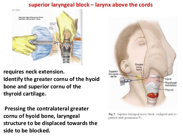 Fiberoptic intubation