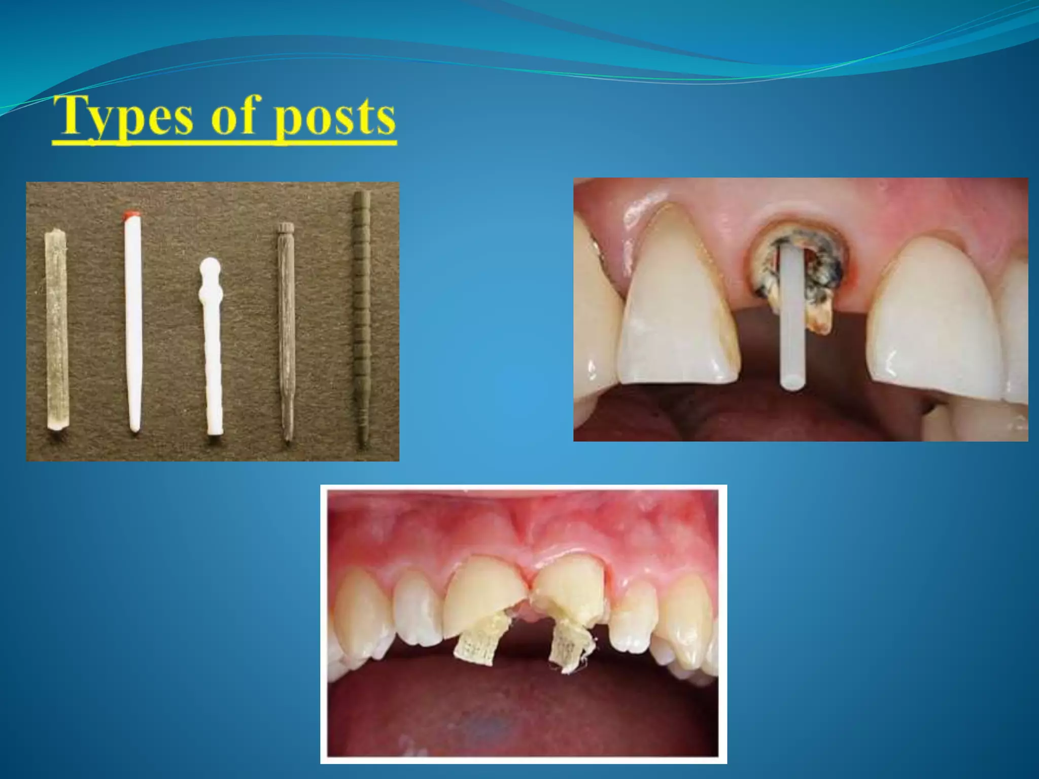Fiber post | PPTX | Dental Health | Diseases and Conditions