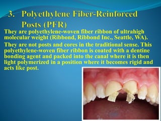 Fiber post | PPTX