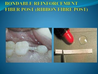 Fiber post | PPTX