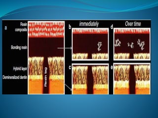 Fiber post | PPTX