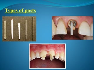 Fiber post | PPTX