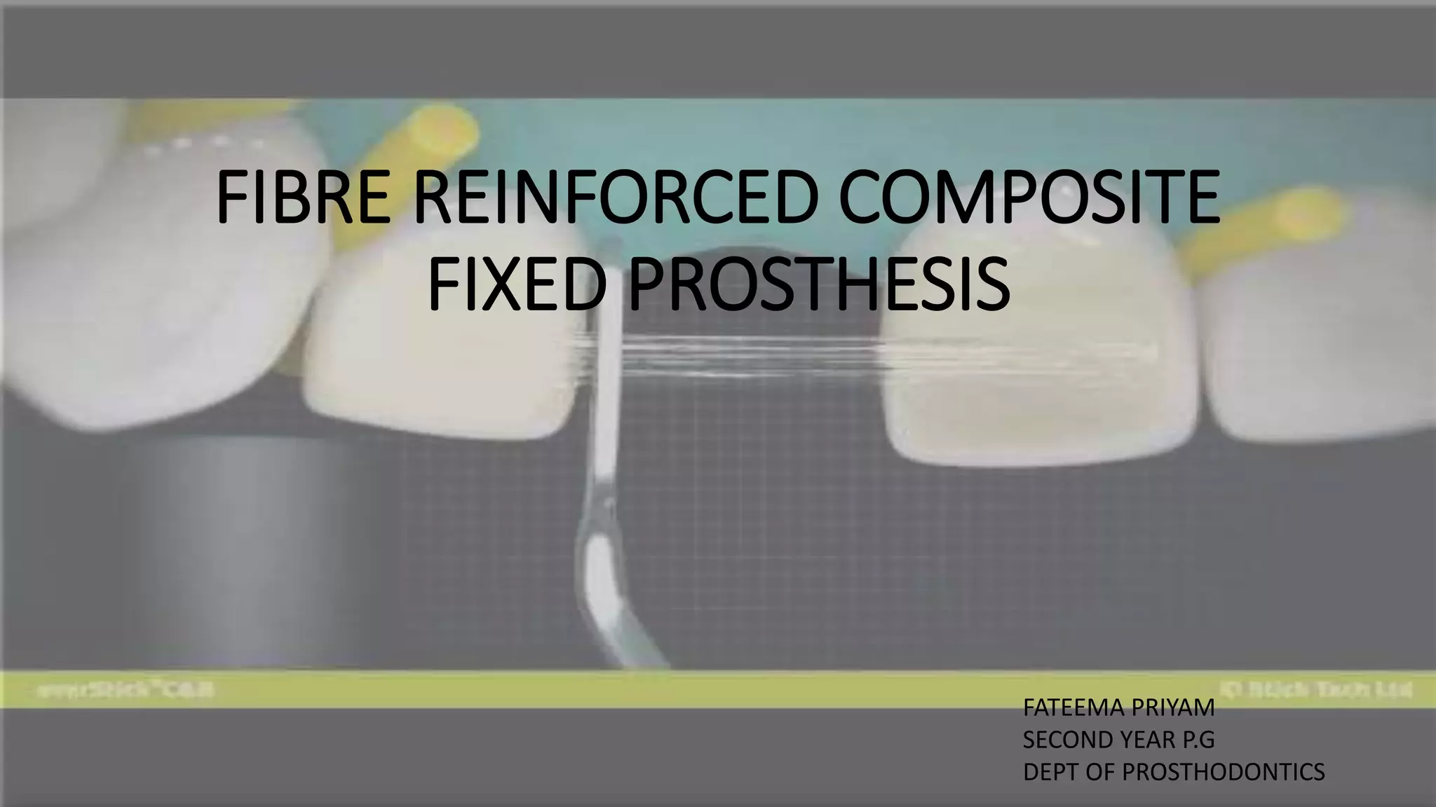Fiber reinforced composite fixed prosthesis | PPTX