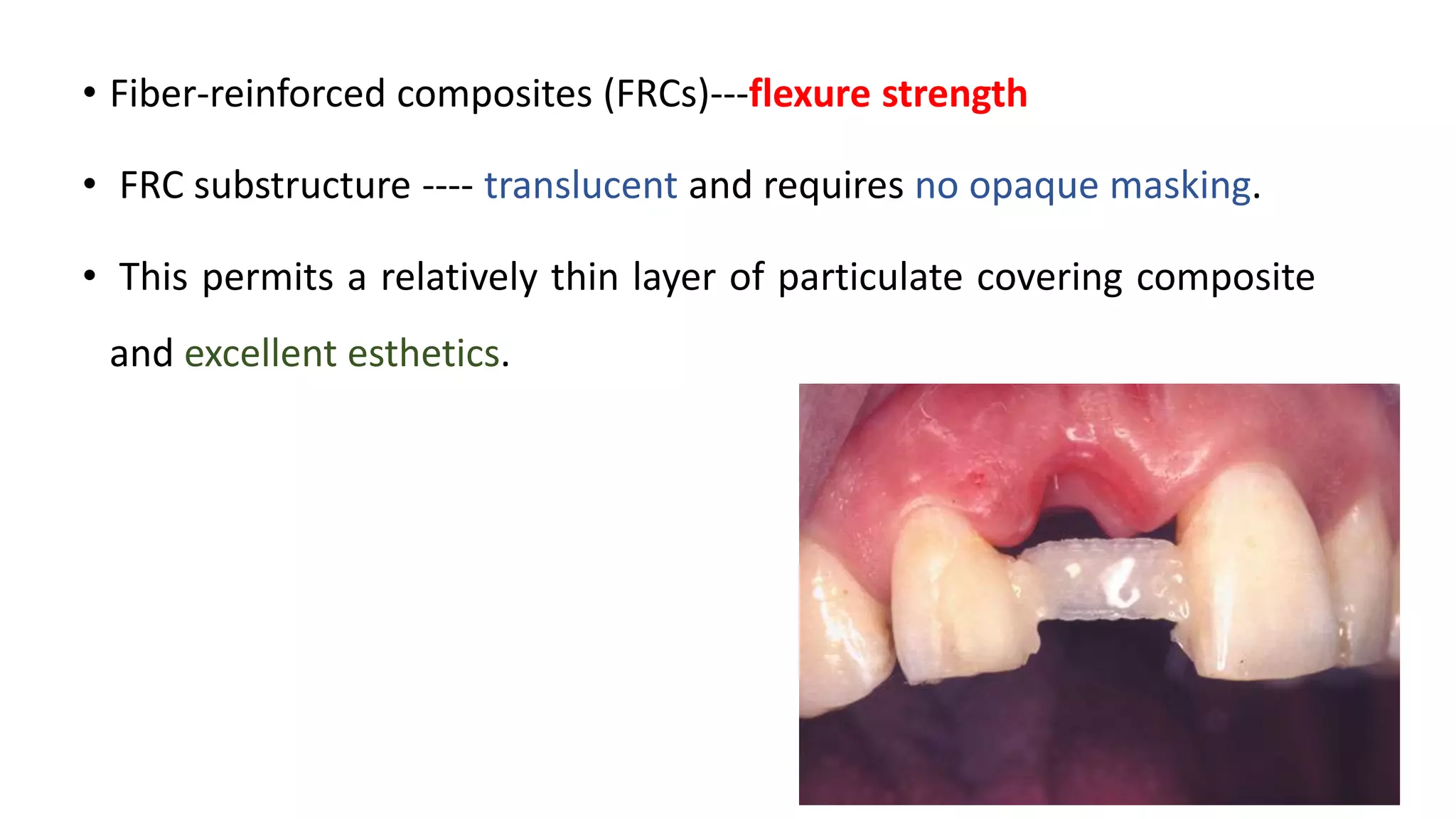 Fiber reinforced composite fixed prosthesis | PPTX