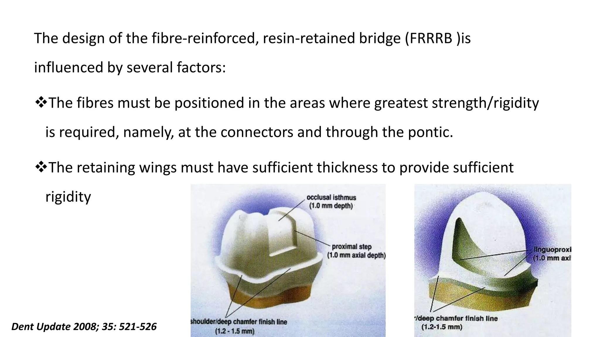 Fiber reinforced composite fixed prosthesis | PPTX