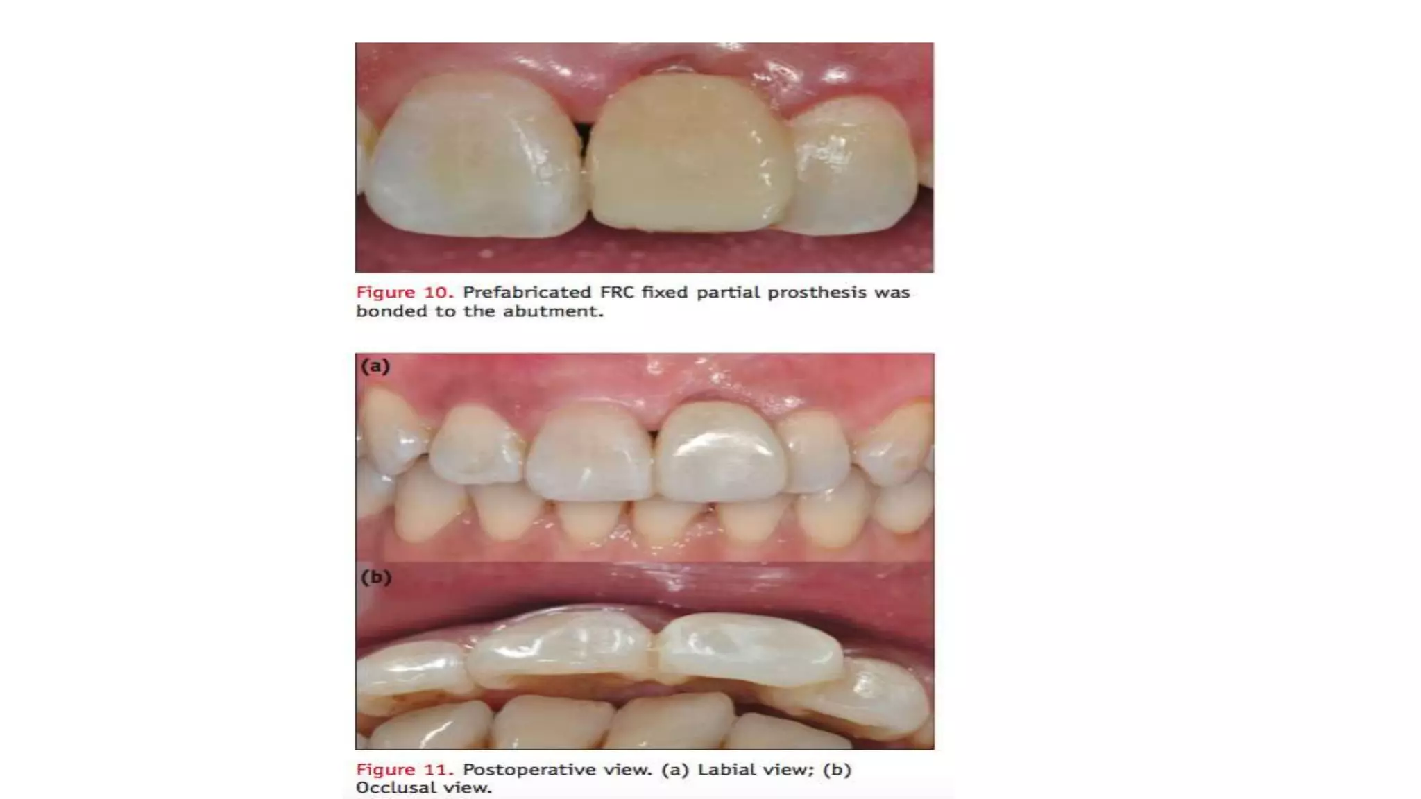 Fiber reinforced composite fixed prosthesis | PPTX